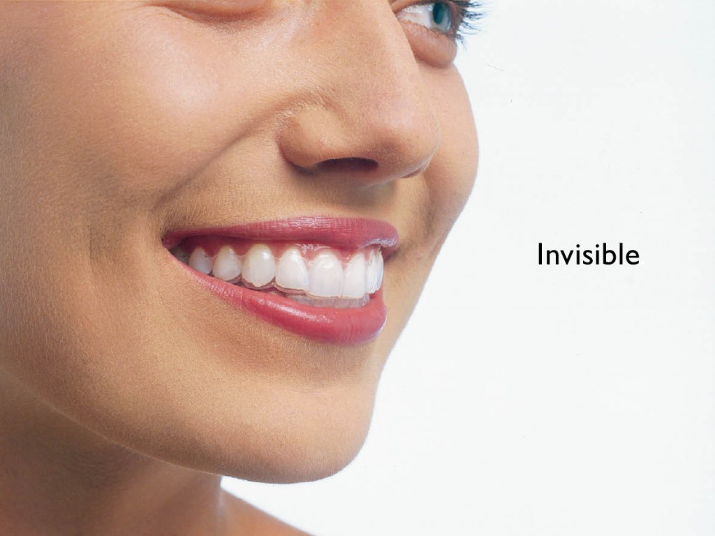 Invisalign® - Orthodontist Cannes - Dr Hayat Steven - Invisalign® Treatment